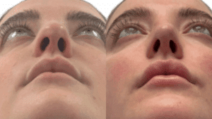 Alar Base Reduction | Alarplasty Cost London | Nostril Reduction