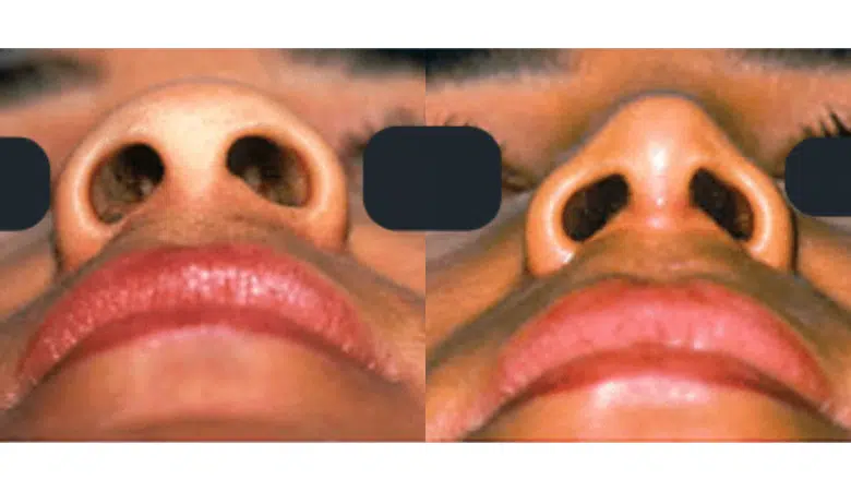 Alar Base Reduction | Alarplasty Cost London | Nostril Reduction