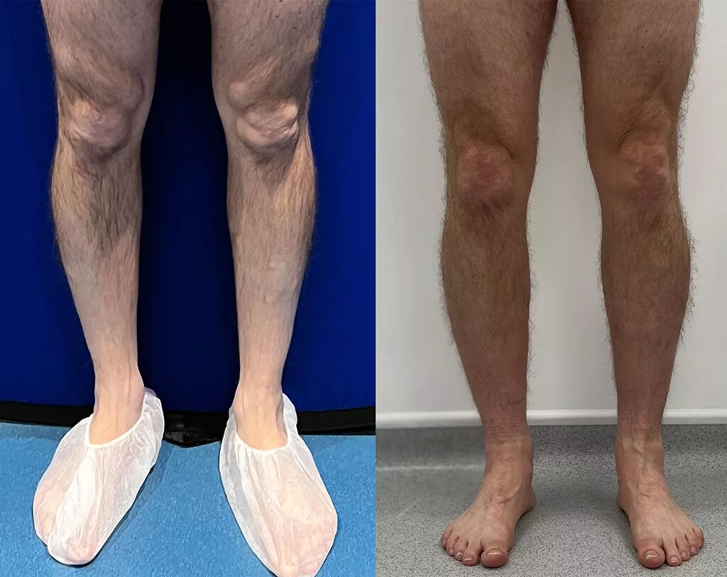 fat dissolving calves