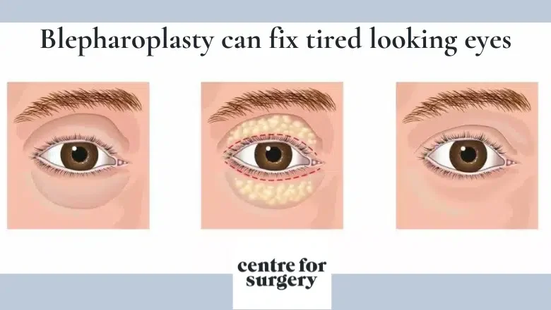 How to Fix Tired Looking Eyes | Centre for Surgery