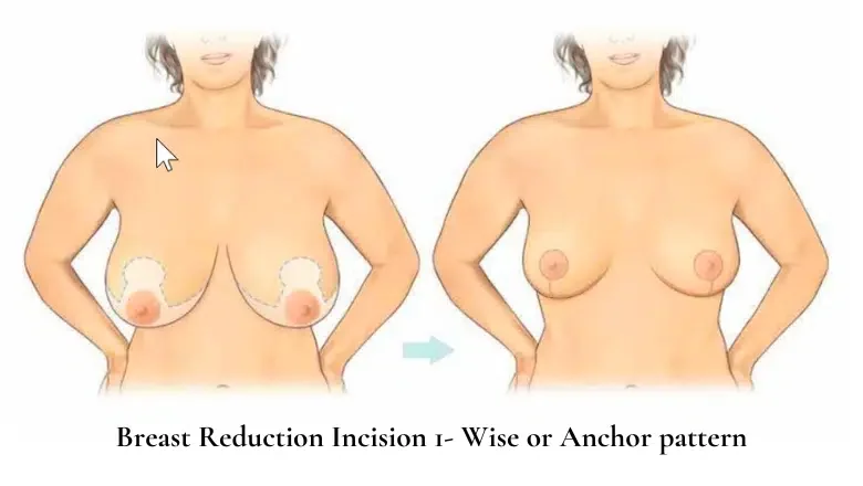 breast reduction uplift and implants